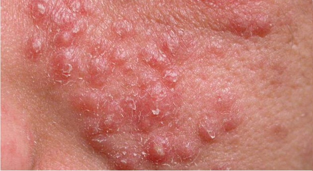 Acne: Cause, Types and Home Remedies - Trends and Health